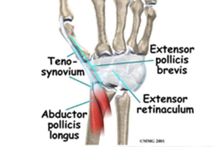De Quervain - Dr. Kuypers Kliniek Hoorn - Hand- en Polscentrum Noord ...