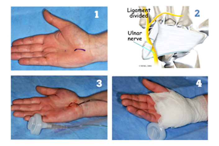 Compressie van de nervus ulnaris in de tunnel van Guyon - Dr. Kuypers ...