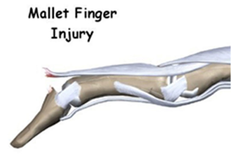 malletfinger-2 - Dr. Kuypers Kliniek