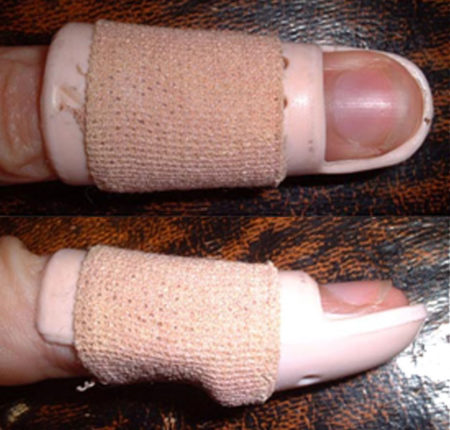 Malletvinger - Dr. Kuypers Kliniek Hoorn - Hand- en Polscentrum Noord ...