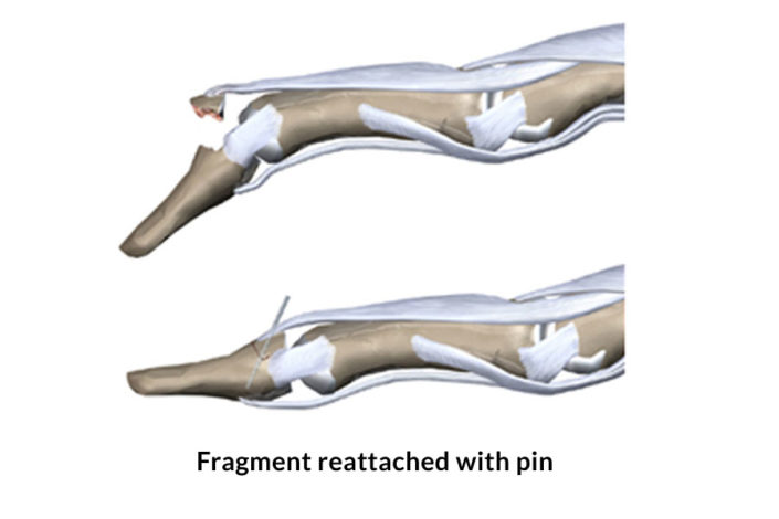 Malletvinger - Dr. Kuypers Kliniek Hoorn - Hand- en Polscentrum Noord ...