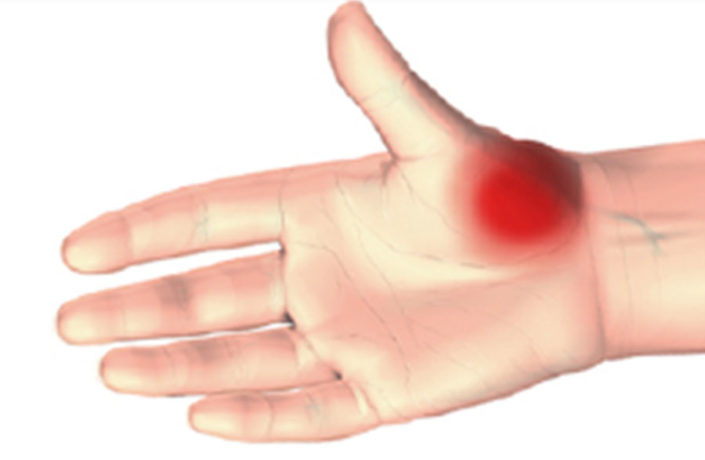 Slijtage duimbasis - Dr. Kuypers Kliniek Hoorn - Hand- en Polscentrum ...