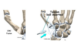 slijtage-duimbasis-operatie - Dr. Kuypers Kliniek
