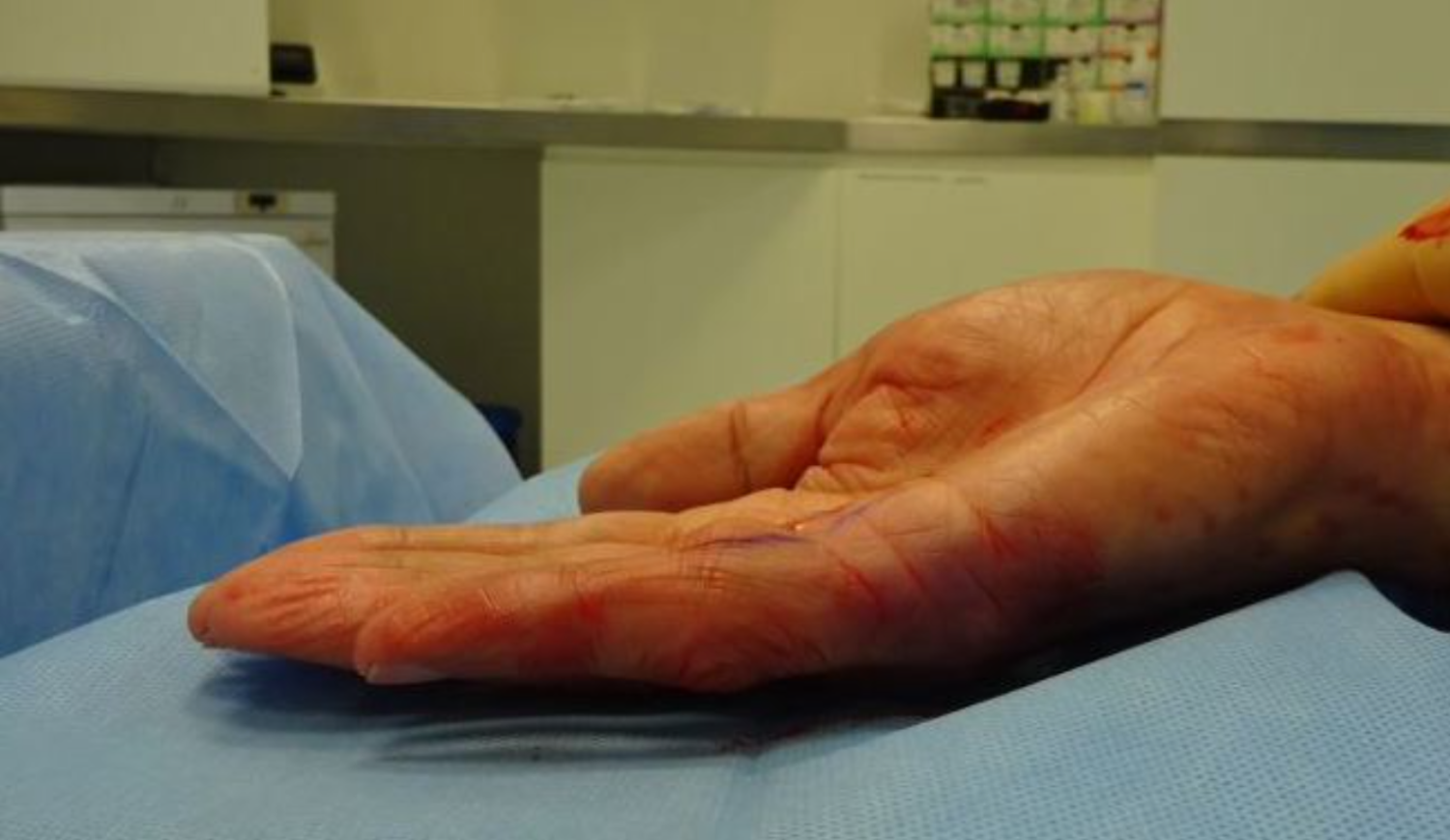 Kromme vinger tijdens eerste bezoek weer recht en na 2 dagen alles weer ...