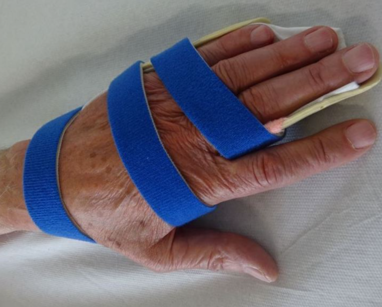 Kromme vinger tijdens eerste bezoek weer recht en na 2 dagen alles weer ...